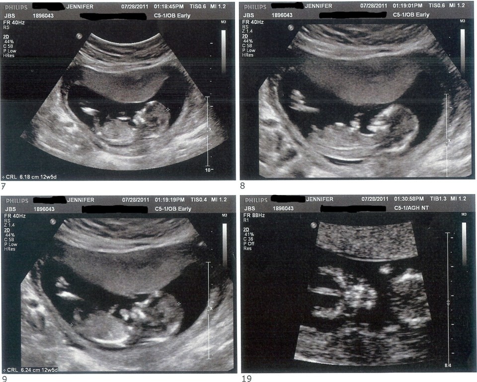 Nuchal Transluncency Ultrasound 12 weeks 4 Days | Fun and Dysfunction